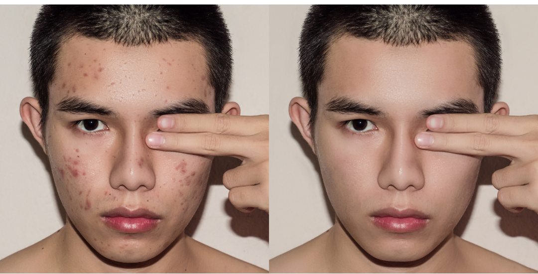 How to get rid of annoying acne? Can compounding help? - Chaparral ...
